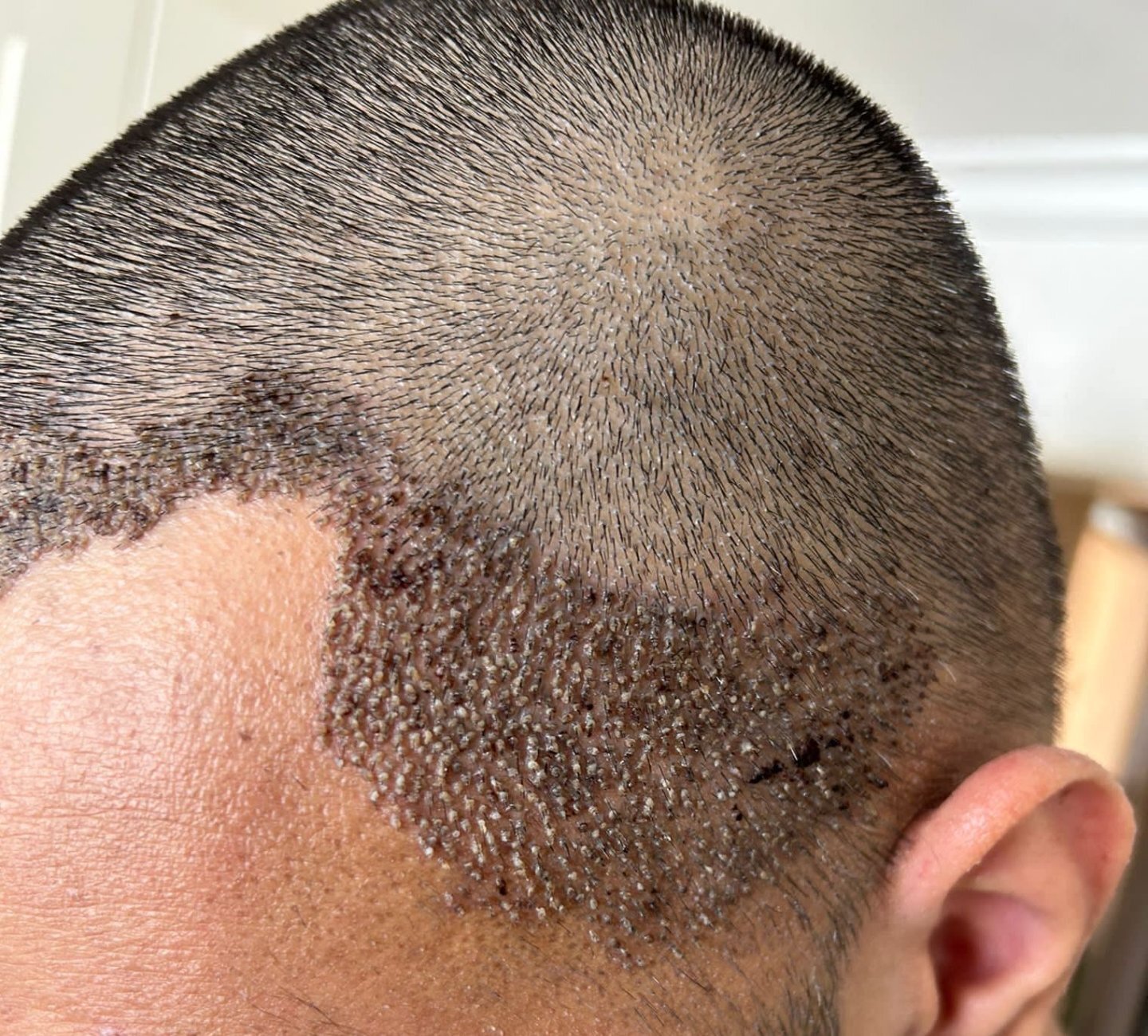 Hair Transplant Turkey - Hair Transplant Reviews - Hair Restoration ...