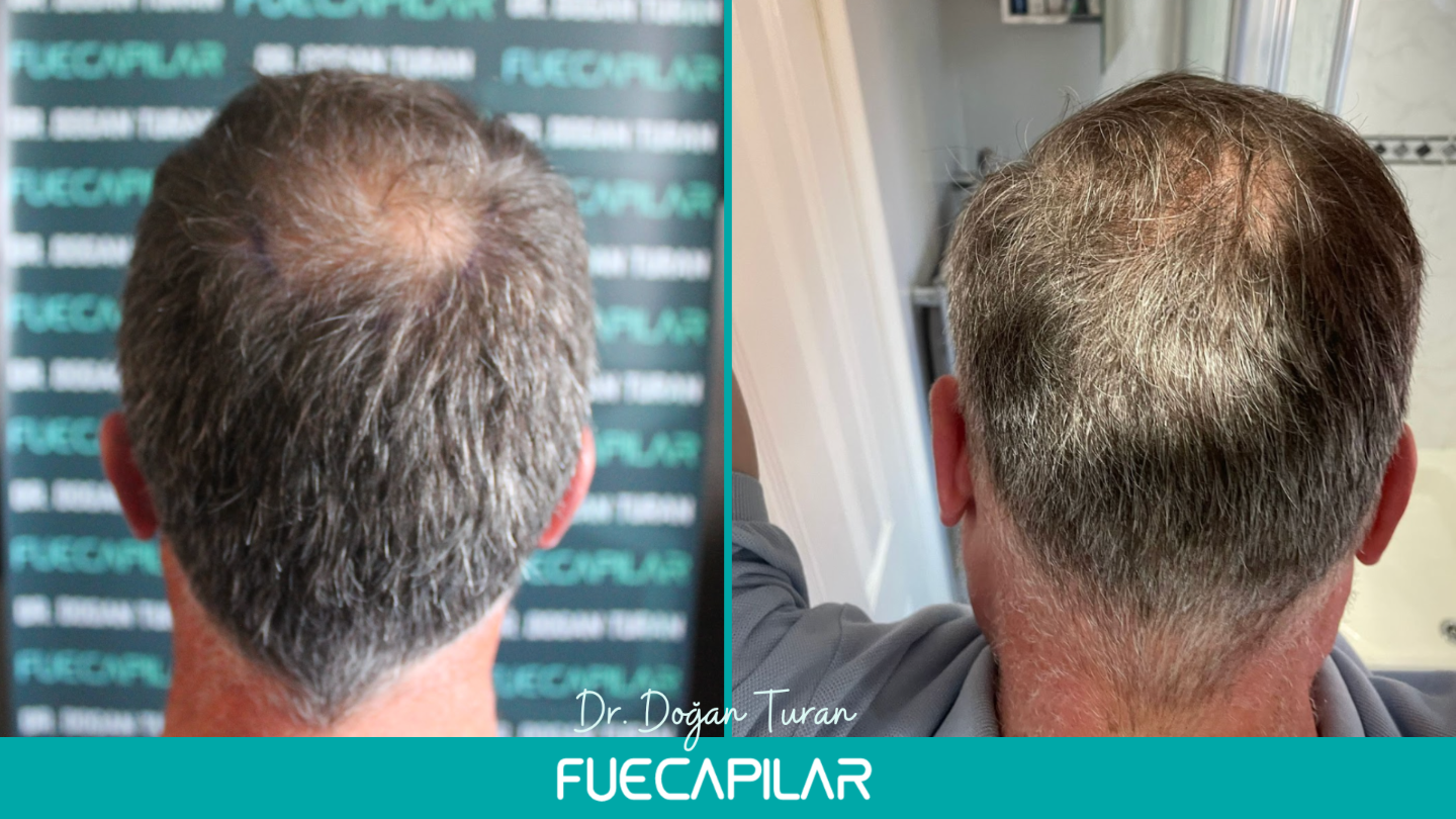 Dr. Turan - FUECAPILAR Clinic, NW IVa with diffuse thinning in the mid ...