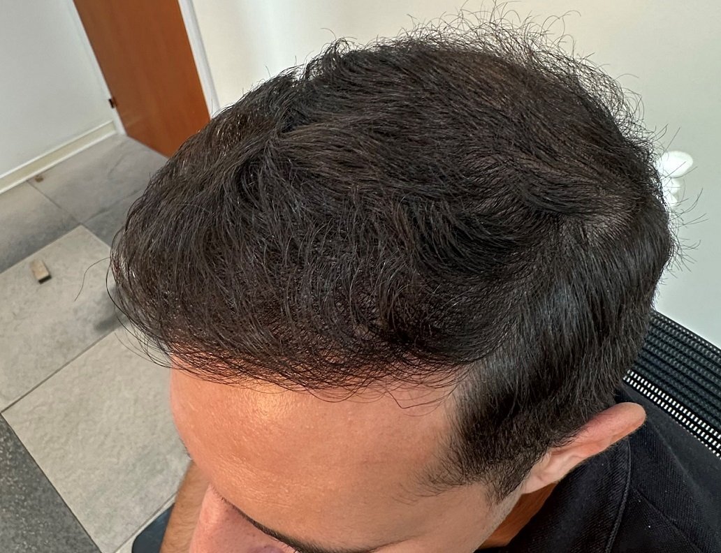 Result of 5000 grafts on NW Class 5 – Giga Session – HDC Hair Clinic ...