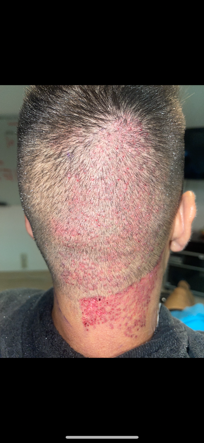 My FUE scars repair - FUE scar repair was 600 + 1.100 + 600 BHT - Dr ...