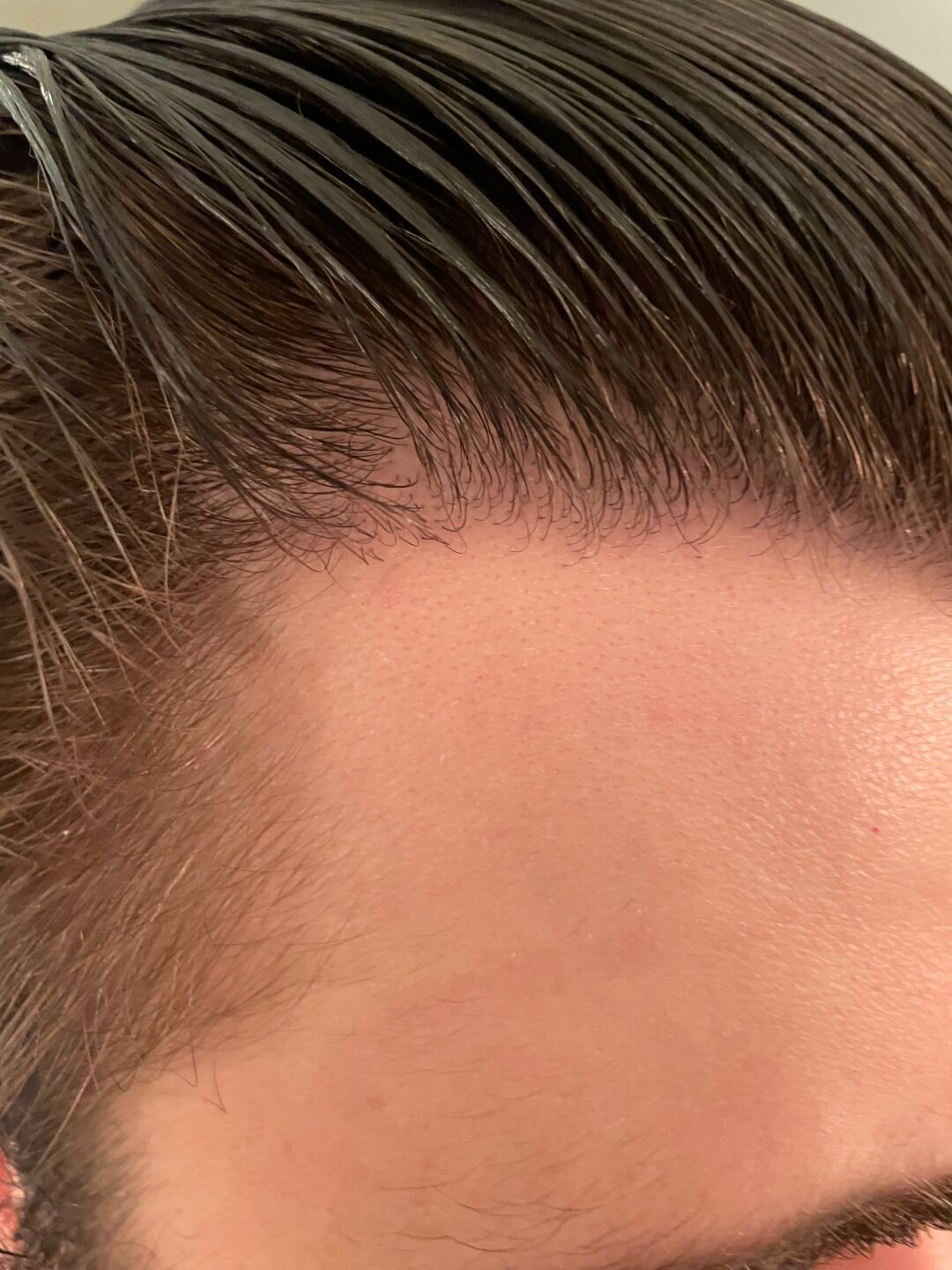Dr. Bloxham 1800 grafts in temples - Hair Transplant Reviews - Hair ...