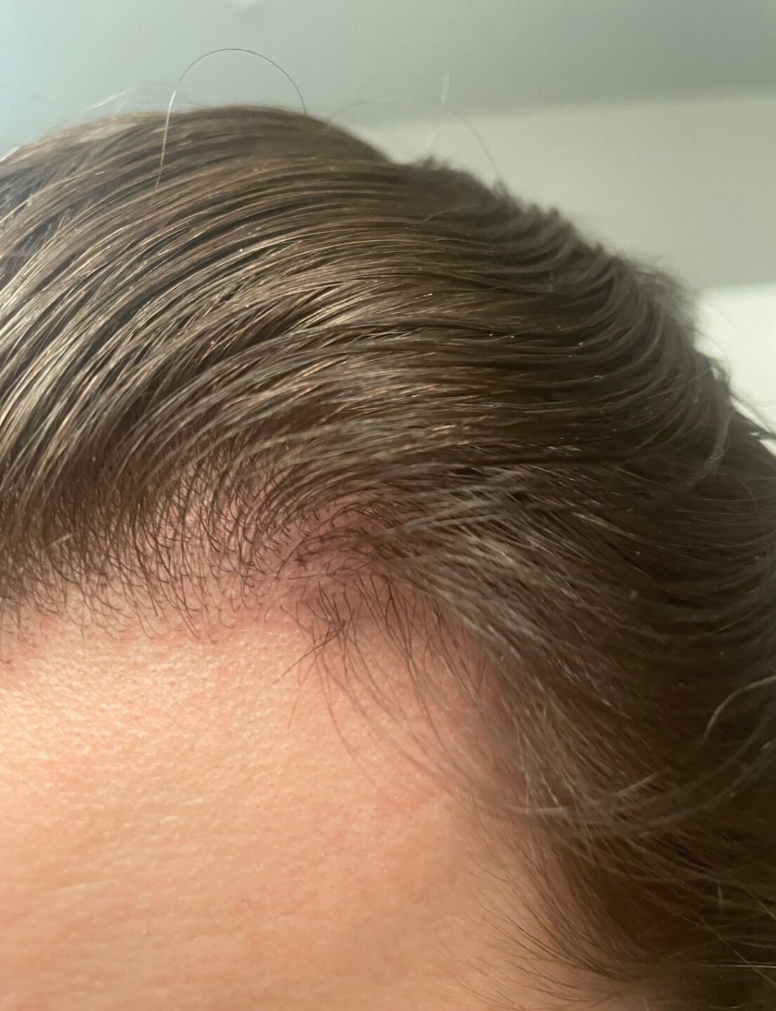 Dr. Bloxham 1800 grafts in temples - Hair Transplant Reviews - Hair ...