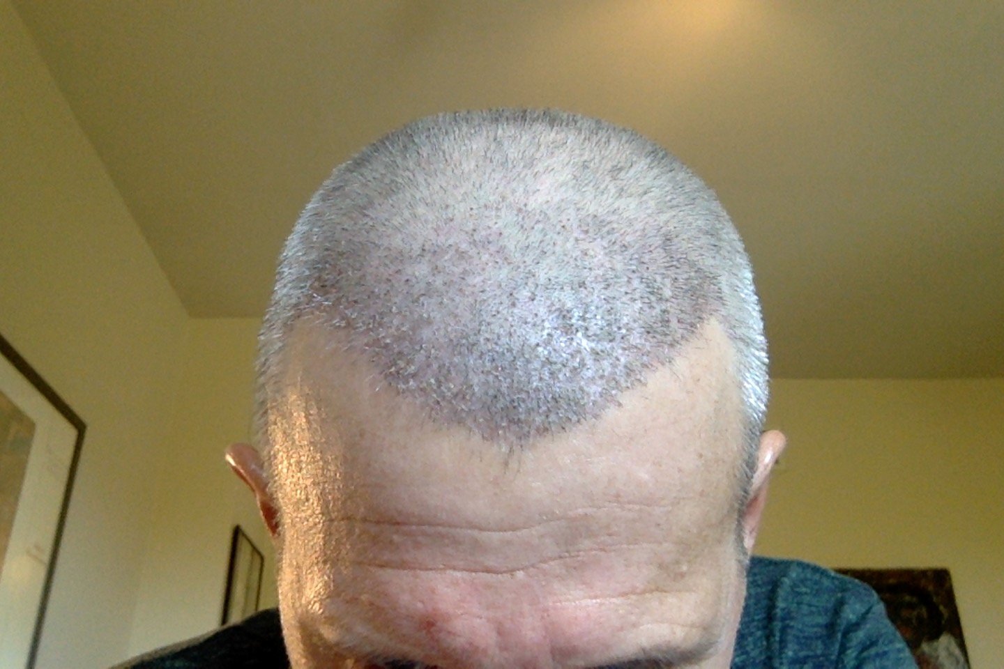 Steven Gabel - Post Fue 5 weeks - Hair Restoration Questions and ...