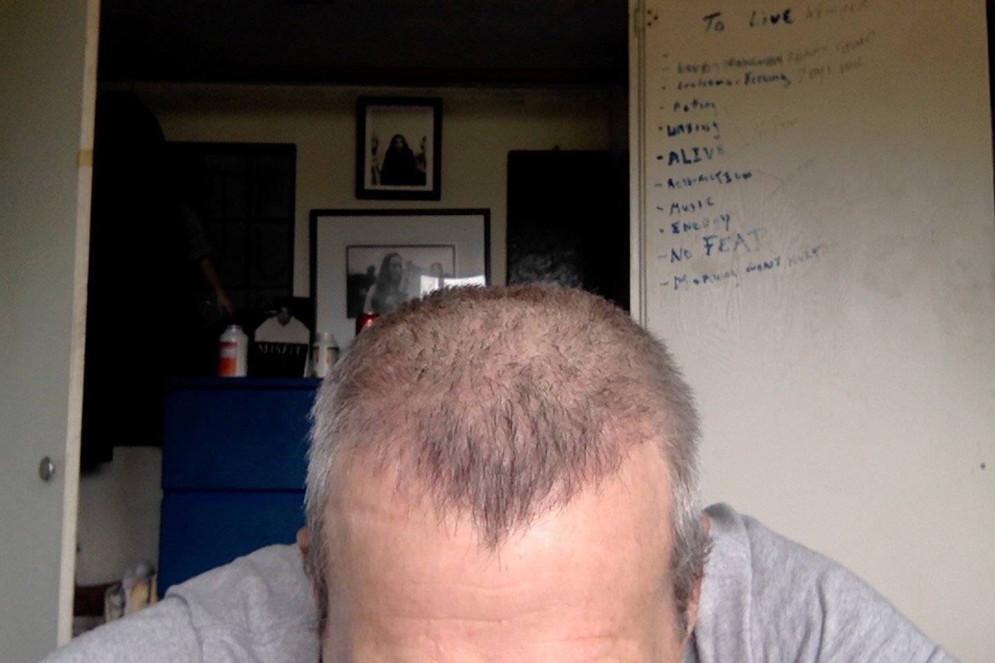Steven Gabel - Post Fue 5 weeks - Hair Restoration Questions and ...