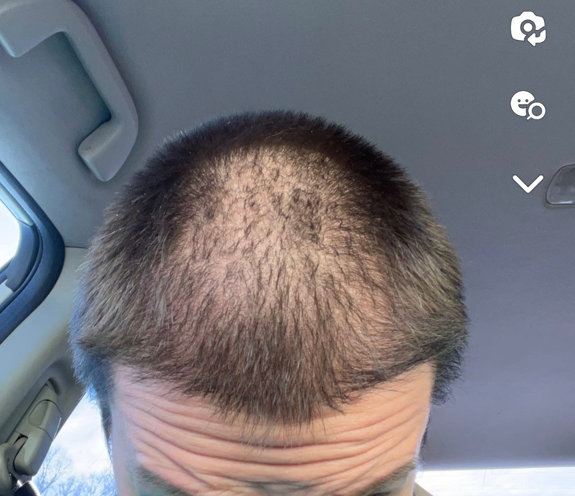 Diffuse thinning FUE reccomendations - Hair Transplant Reviews - Hair ...