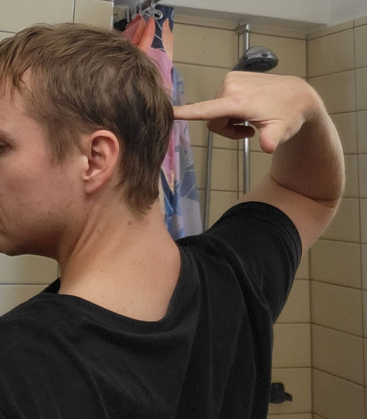 I bumbed my head before my hair transplant. Is that a problem? - Hair ...