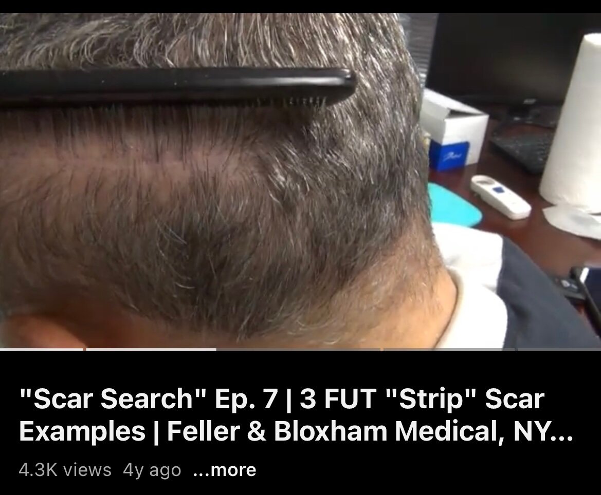 Restoring temporal points: is it worth it? - Hair Restoration Questions ...