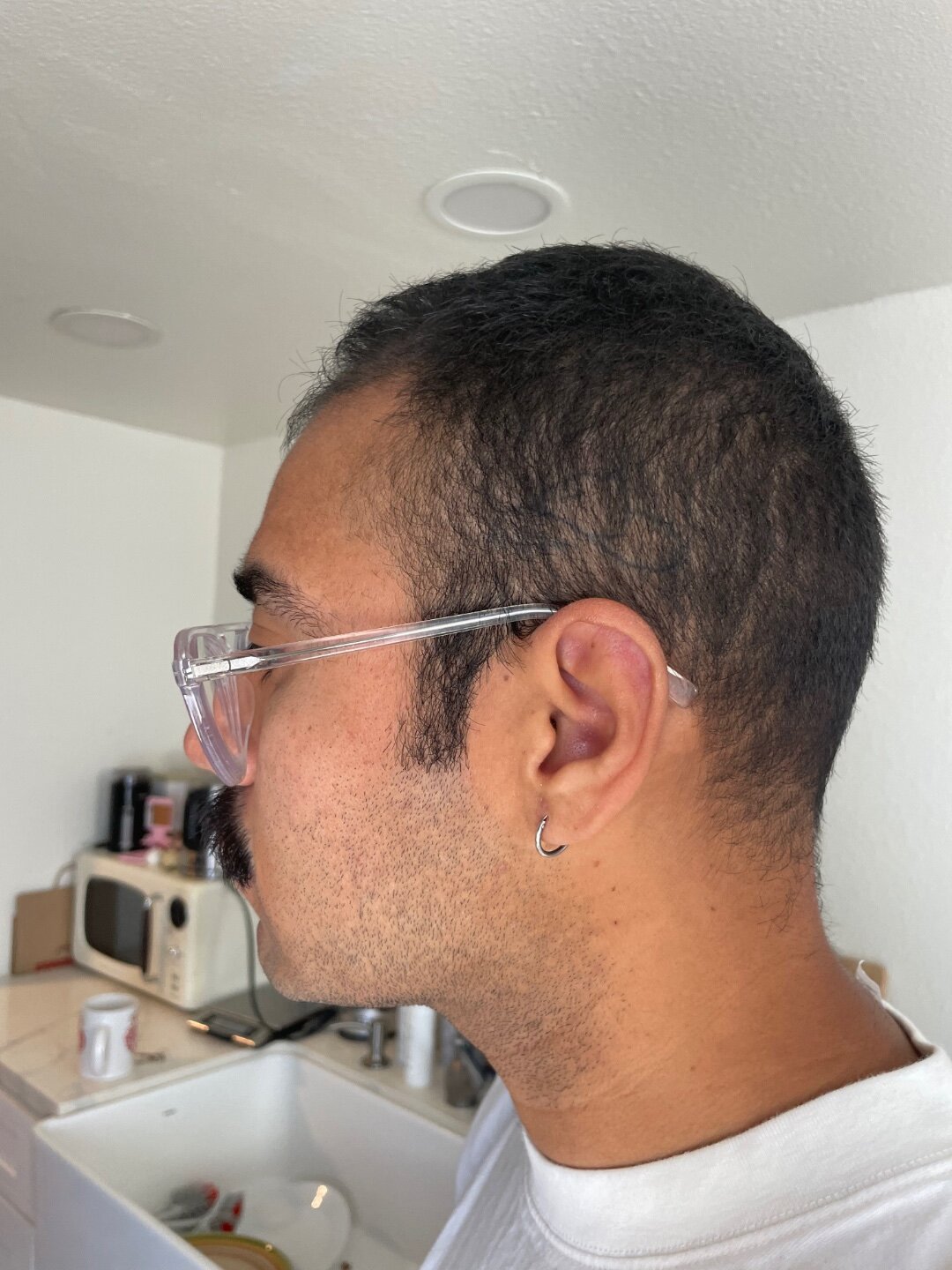 Restoring temporal points: is it worth it? - Hair Restoration Questions ...