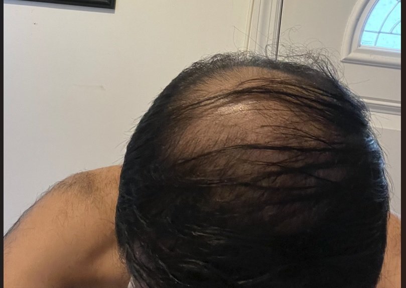 Revisiting the Hair Transplant question/decision after coasting along ...