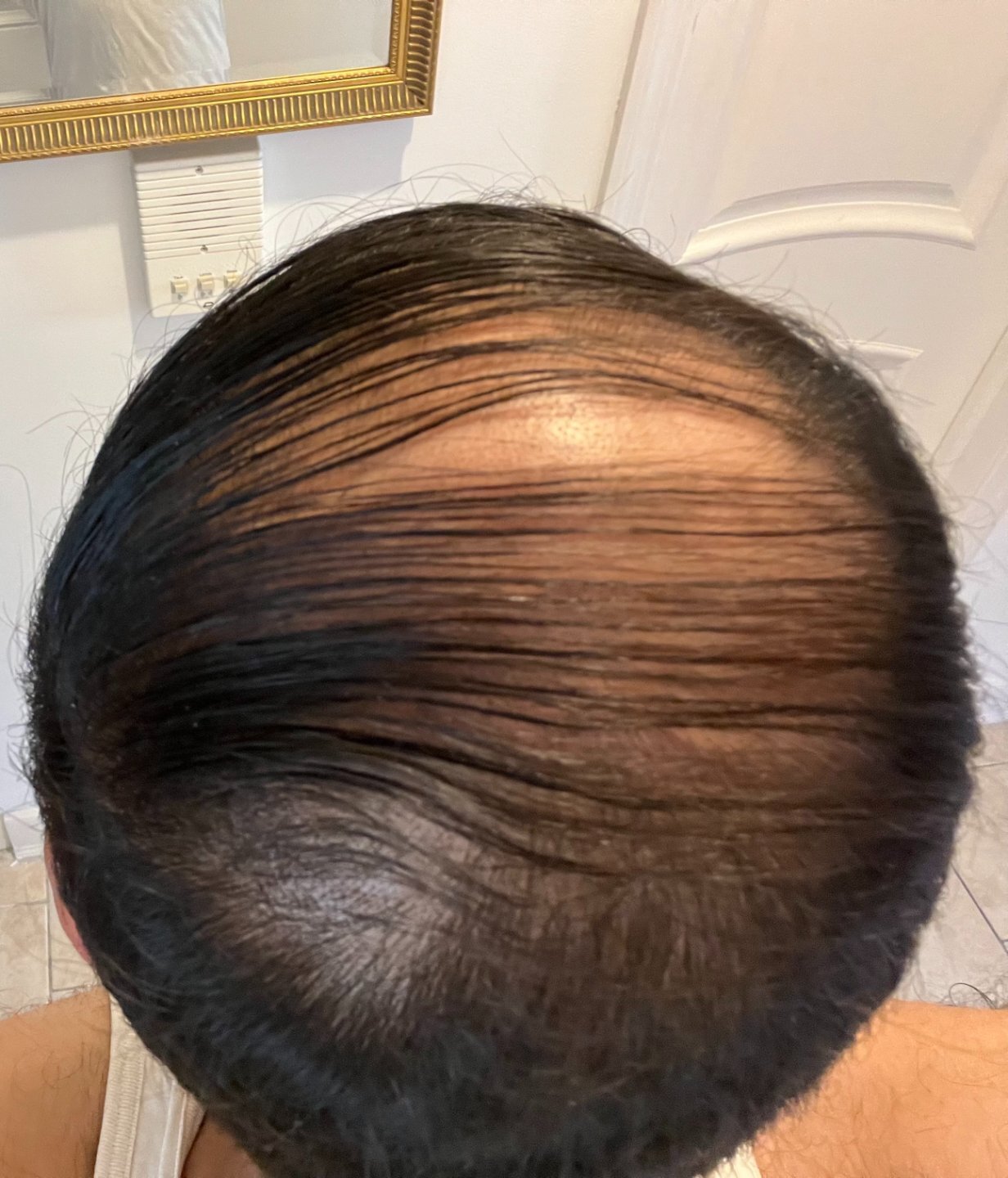 Revisiting the Hair Transplant question/decision after coasting along ...