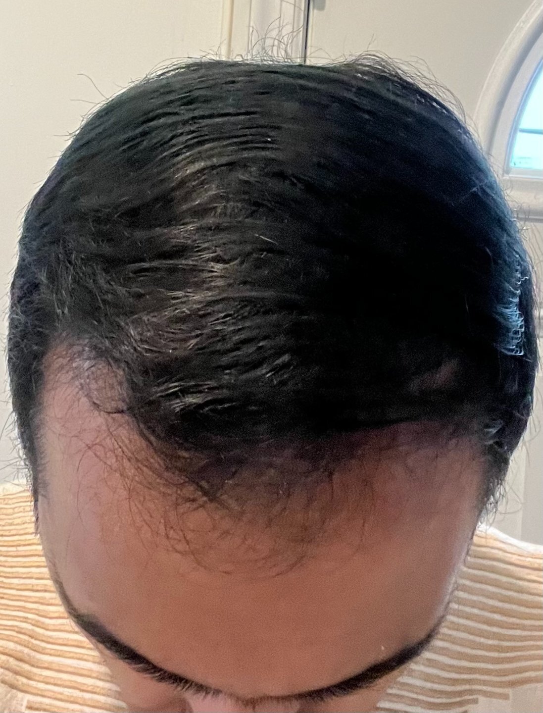 Revisiting the Hair Transplant question/decision after coasting along ...