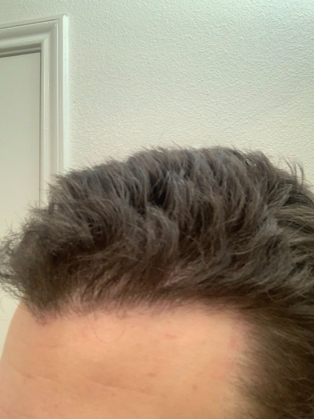 Calling all experts: Please help me find an FUE Hairline Specialist ...