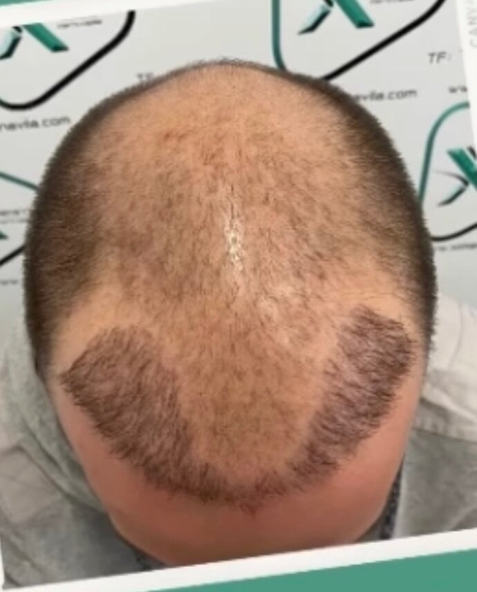 will any reputable doctors perform on a 20 year old? - Hair Restoration ...