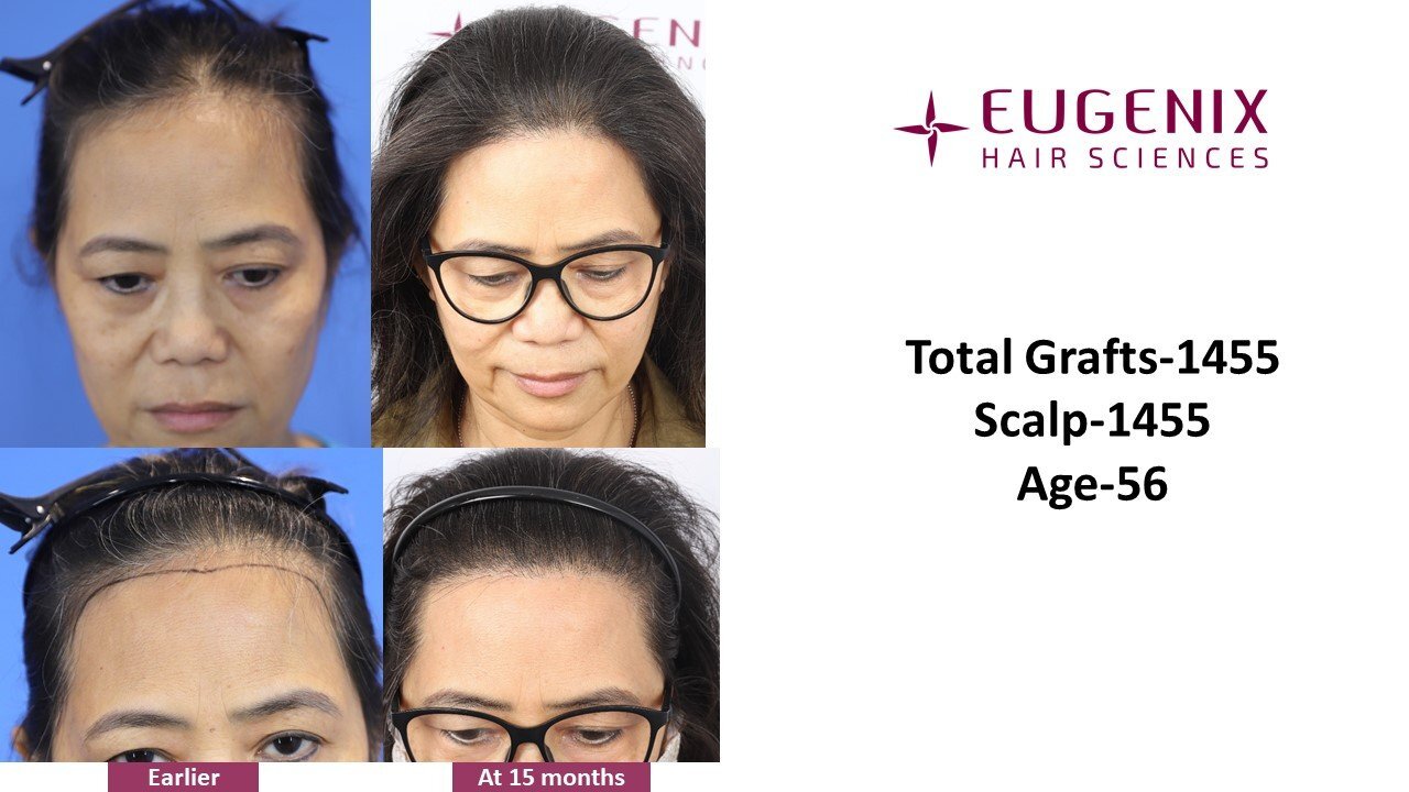 Dr. Pradeep Sethi| Eugenix Hair Sciences Clinic| 1455 Grafts | 15 ...
