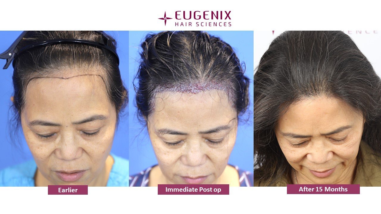 Dr. Pradeep Sethi| Eugenix Hair Sciences Clinic| 1455 Grafts | 15 ...