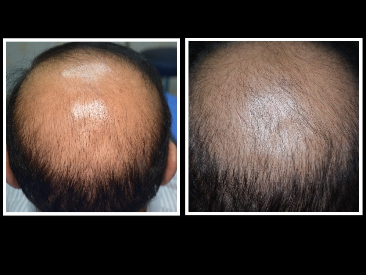 Will there ever be a surgery/pill that will regrow hair within a month ...