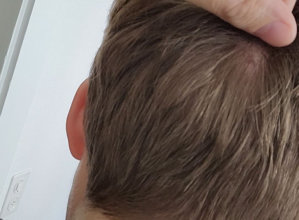 I bumbed my head before my hair transplant. Is that a problem? - Hair ...