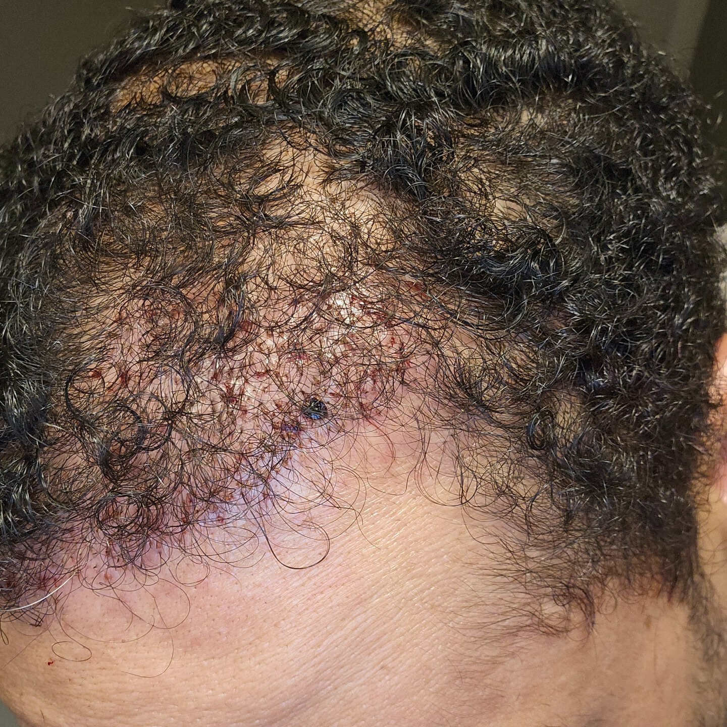 Did I dislodge a graft? Had FUE procedure this morning - Hair ...