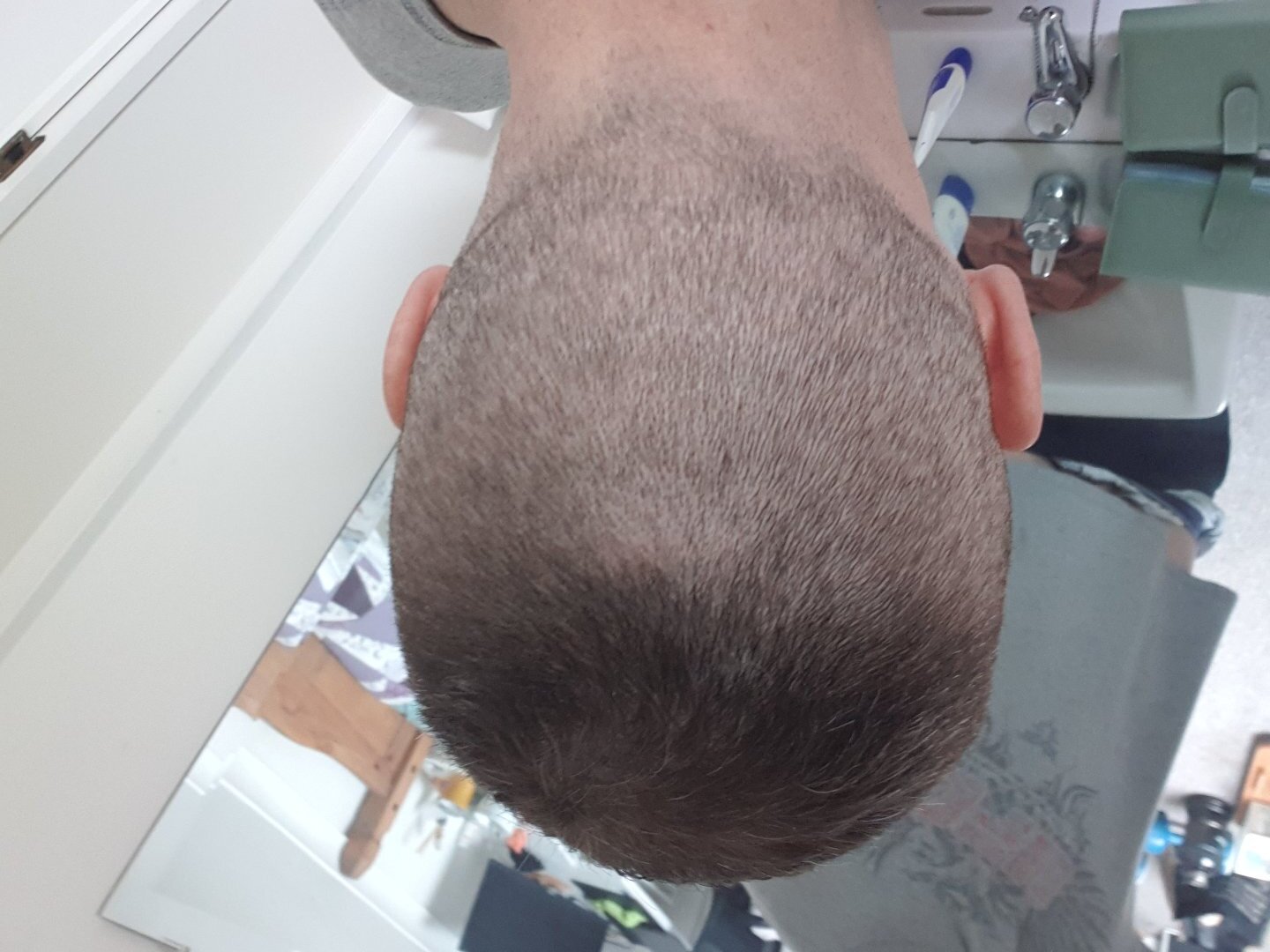 Final pattern - Hair Restoration Questions and Answers - Hair ...