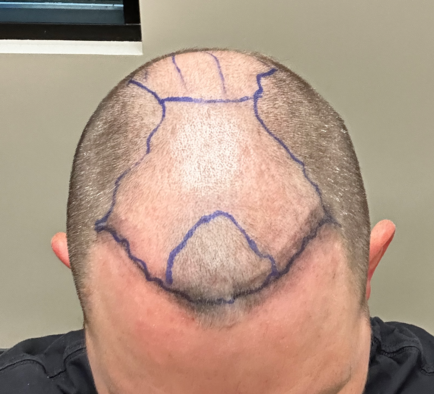 Dr. Steven Gabel - FUE 2,261 grafts - Hair Transplant Reviews - Hair ...
