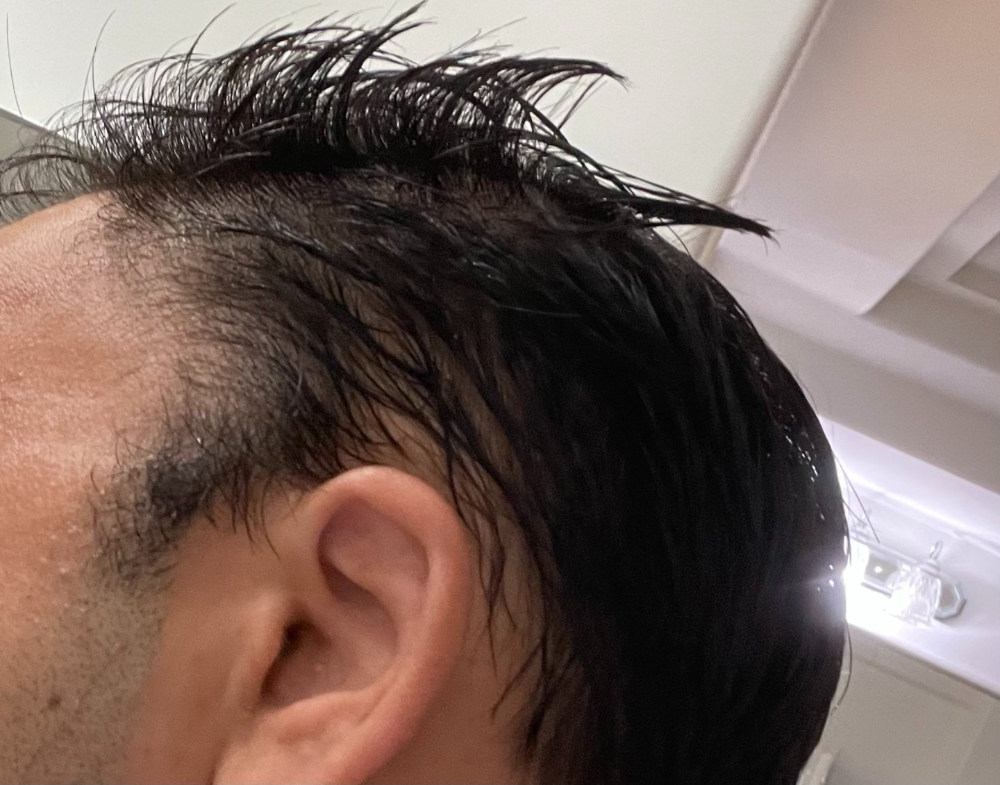 So Cal Hair restoration doctors - Hair Restoration Questions and ...