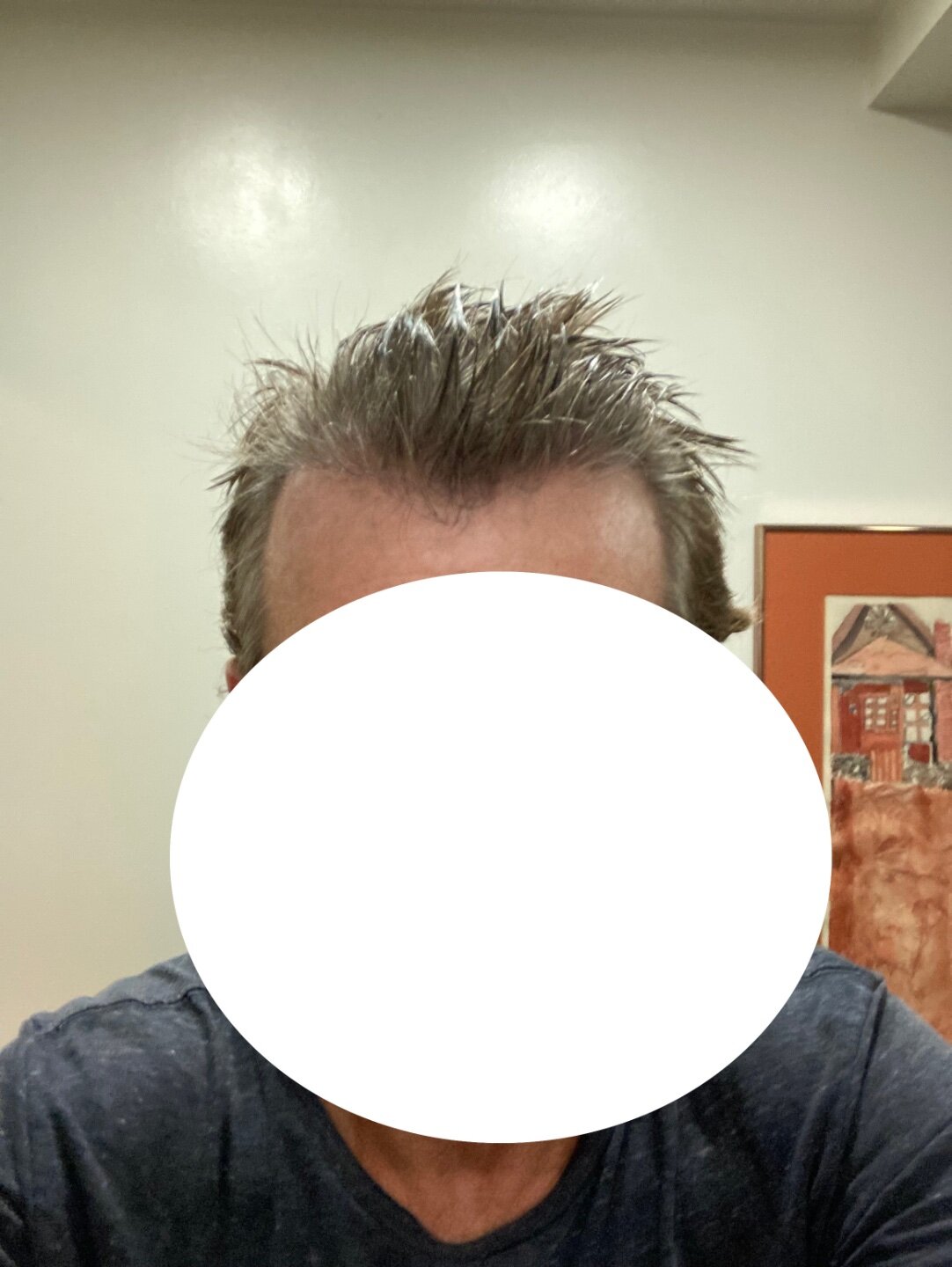 Steven Gabel - Post Fue 5 weeks - Hair Restoration Questions and ...