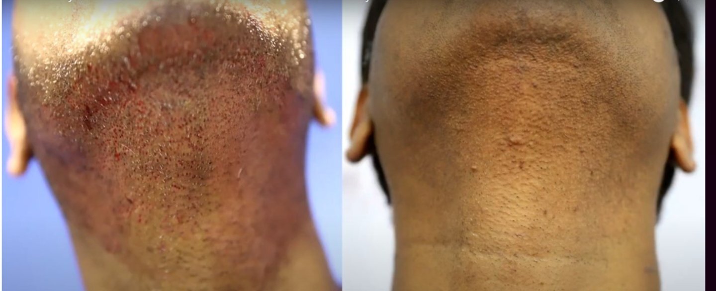 Revisiting the Hair Transplant question/decision after coasting along ...