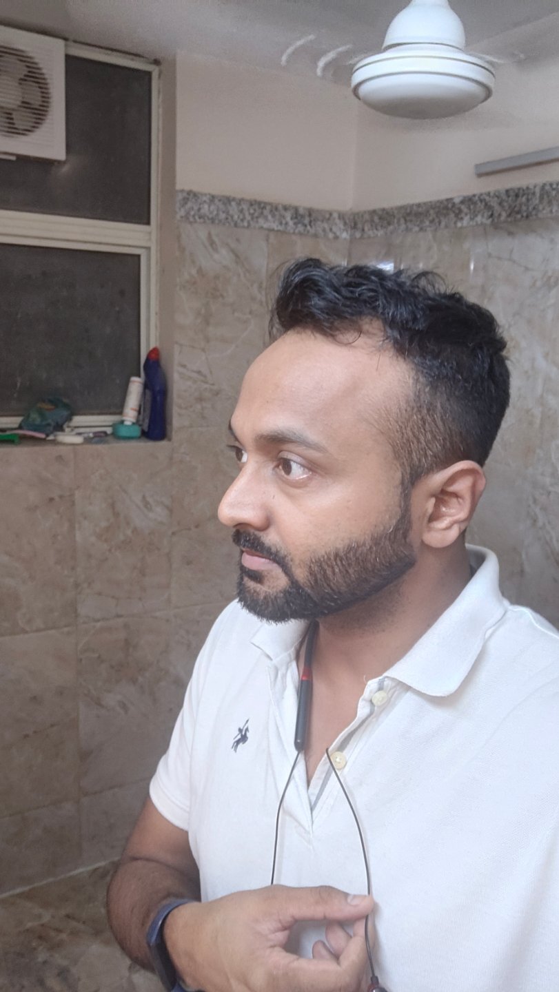 Do I need hair transplant or can the min/fin/micron fix this? - Hair ...