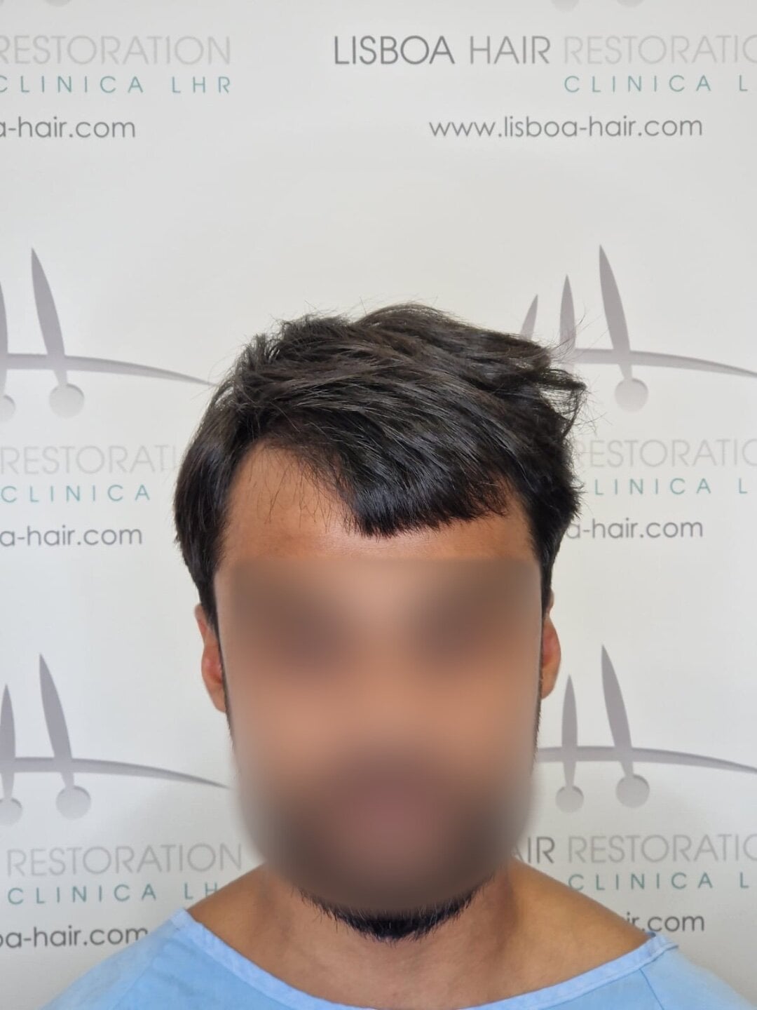 3000 grafts FUE & DHI - Clinia LHR in Lisbon - Dr Augusto Guerreiro ...