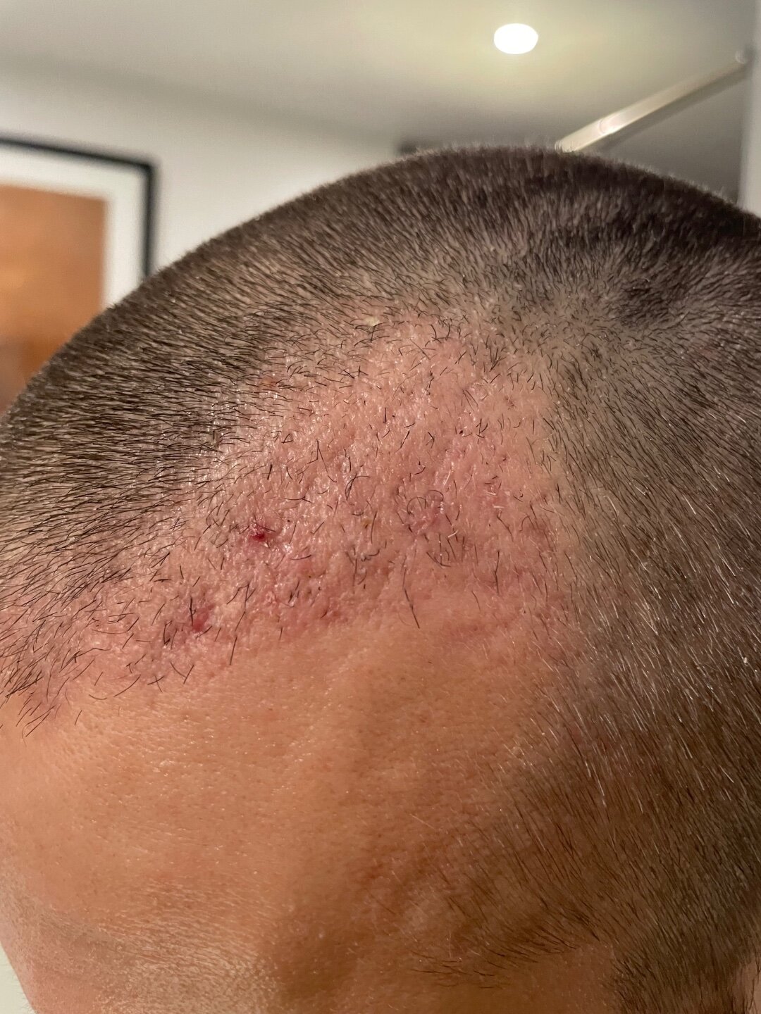 Bleeding after trimming - Hair Restoration Questions and Answers - Hair ...