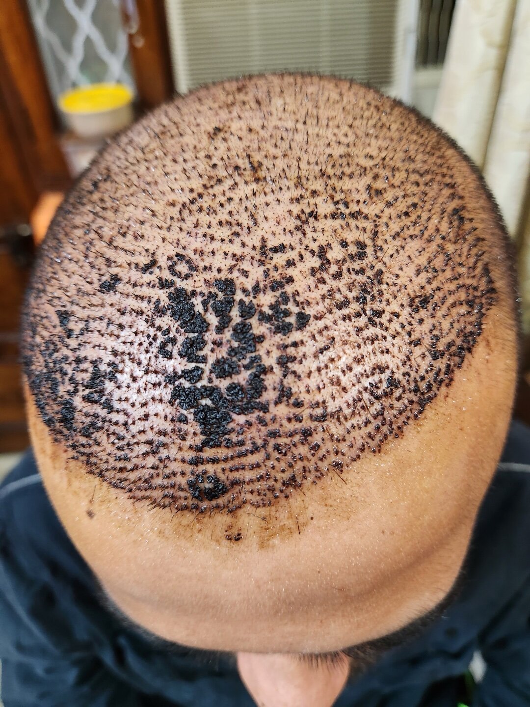 Need advice on the course of action after a bad Hair Transplant - Hair ...