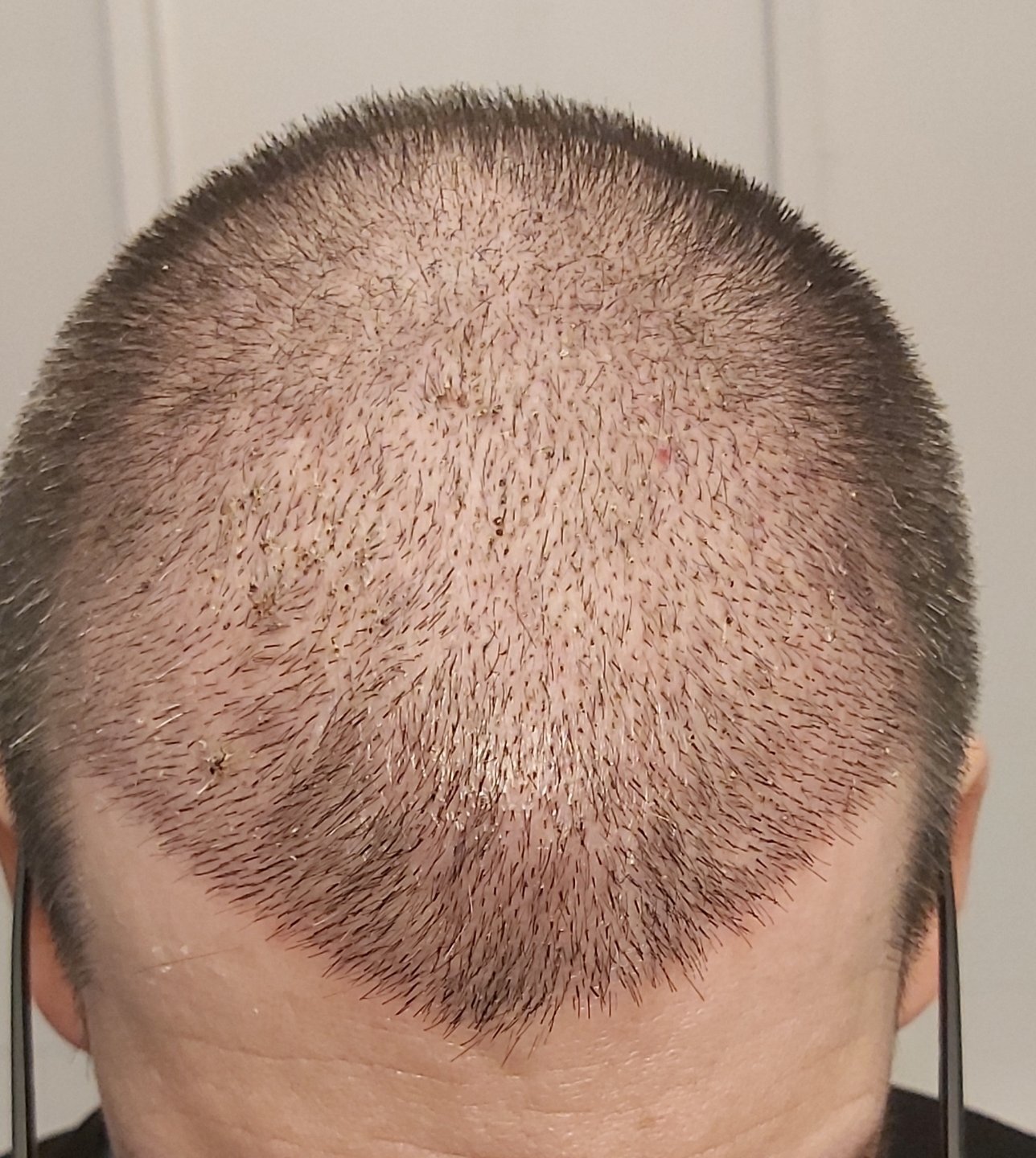 Scabs Feel Hard & Are Difficult to Dislodge - Hair Restoration ...