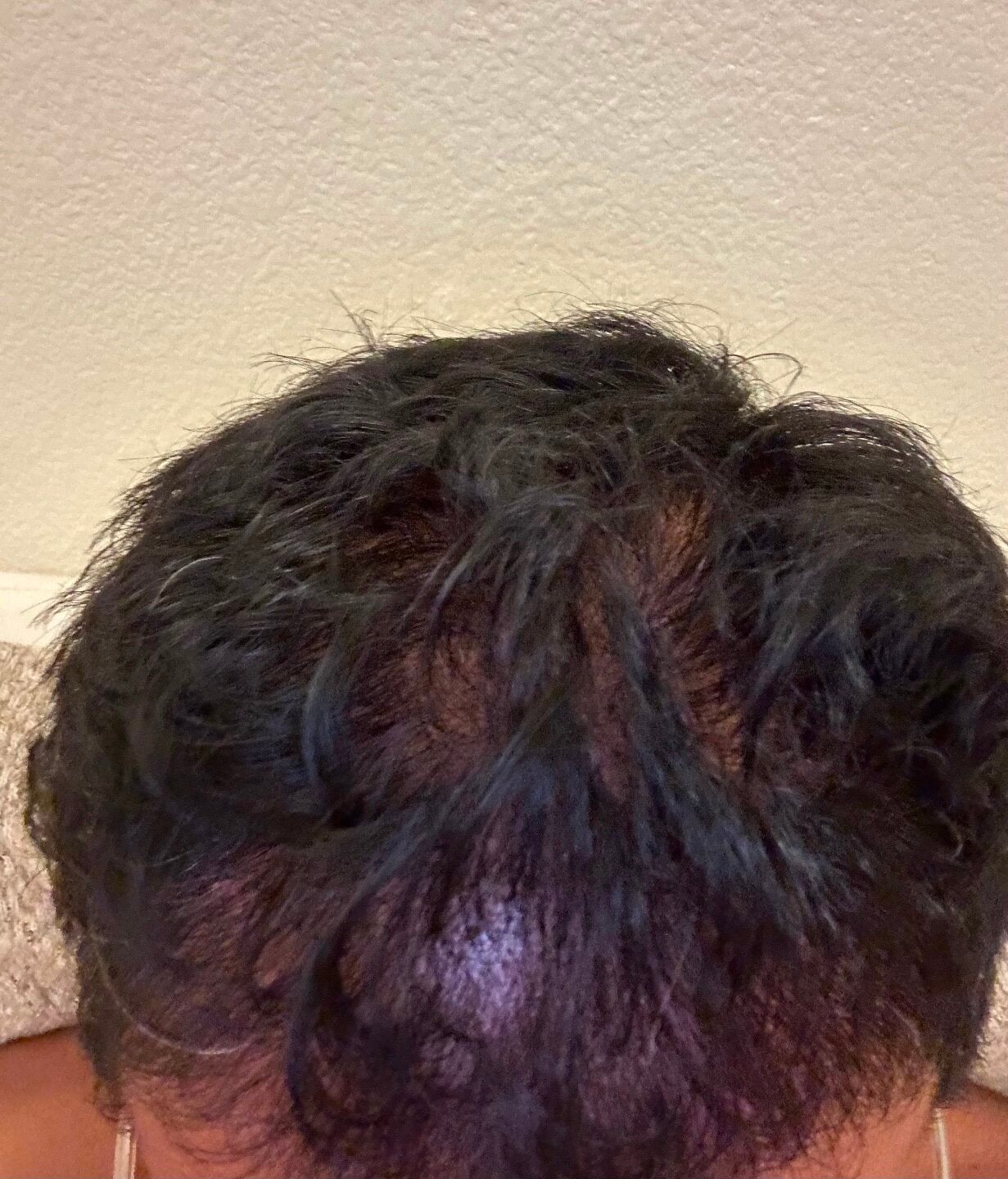 Is this shock loss at month 4? - Hair Restoration Questions and Answers ...