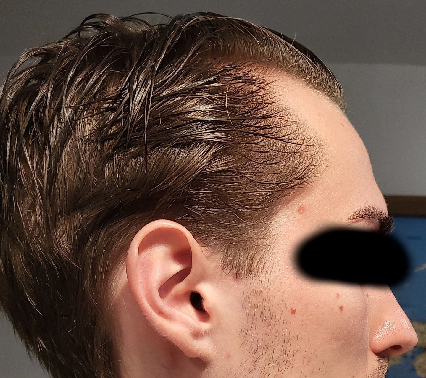 29 y/o, Norwood 2.5, How many Grafts | Surgeon | Hairline design ...
