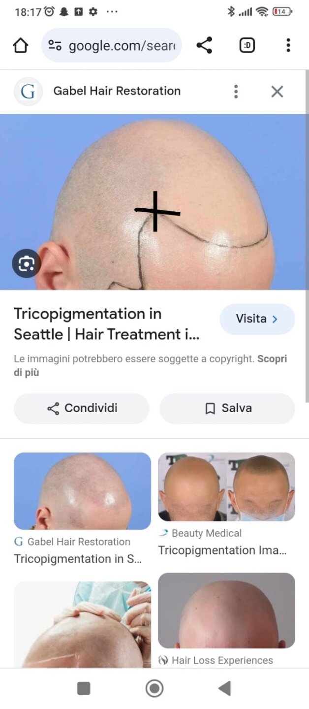 hairline design - the frontotemporal angle - Hair Restoration Questions ...