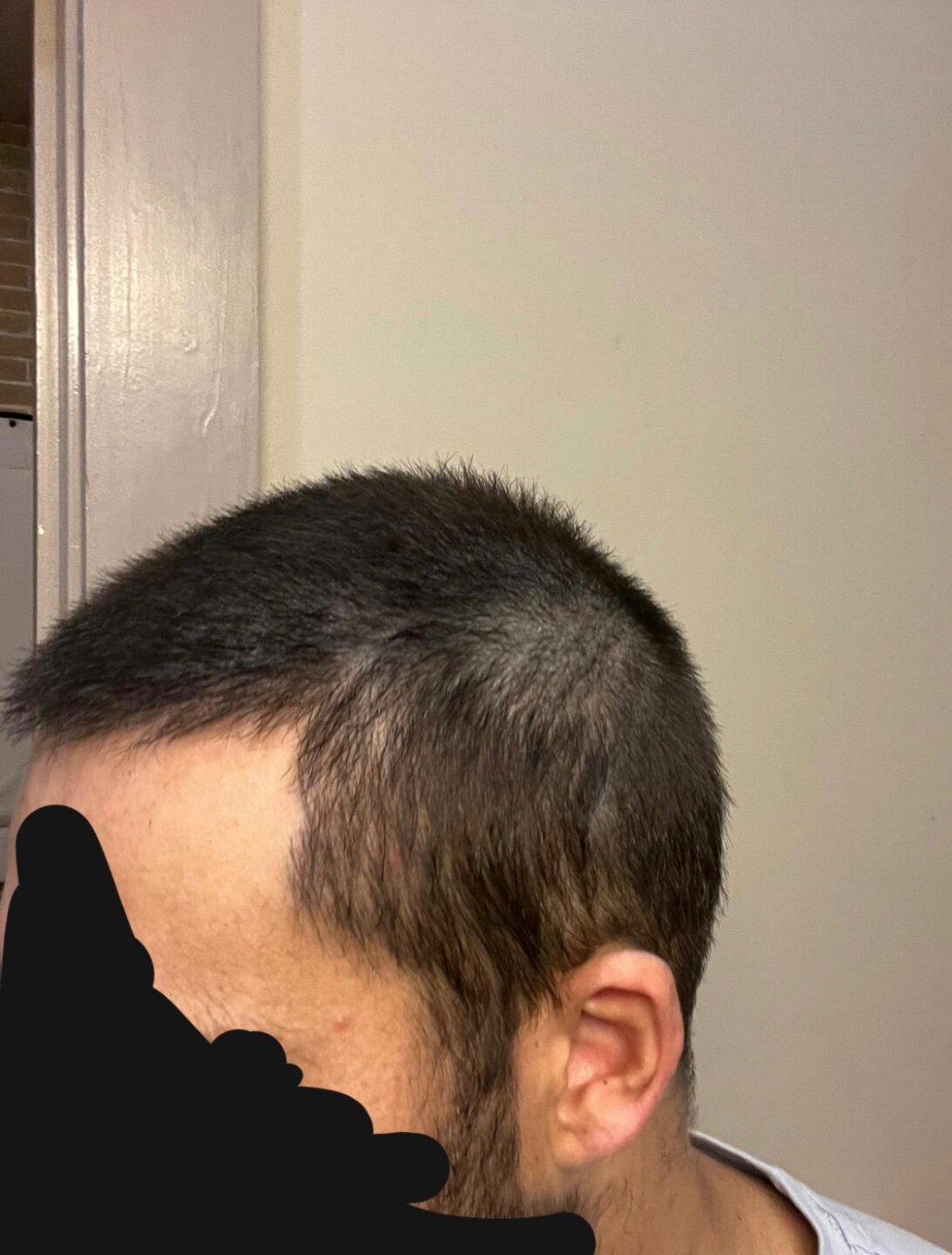 SMP fix over harvest? - Hair Transplant Reviews - Hair Restoration ...