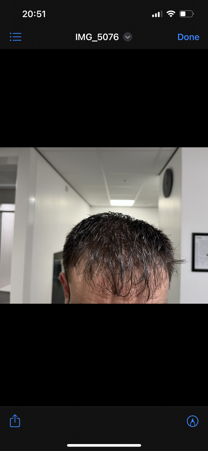 Do Hair Transplant fade over time? - Open Hair Loss Topics - Hair ...