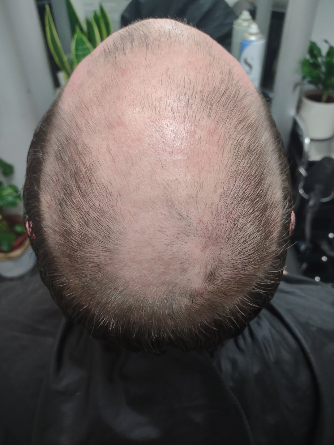 Am I Norwood 6 or 7? - Hair Restoration Questions and Answers - Hair ...