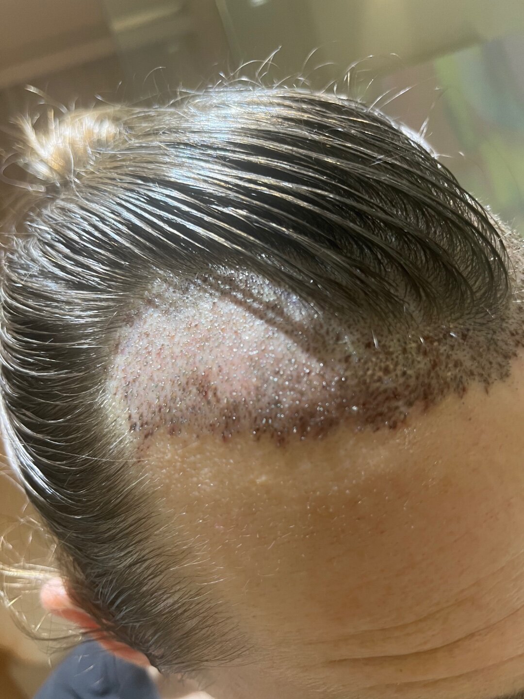 Bumped head - 3days post op - Hair Restoration Questions and Answers ...