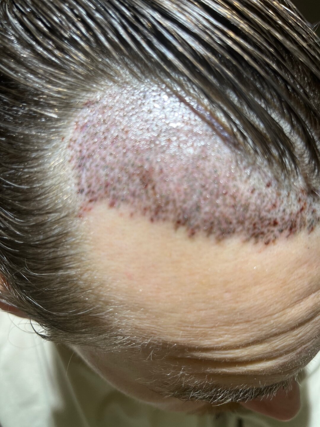 Bumped head - 3days post op - Hair Restoration Questions and Answers ...