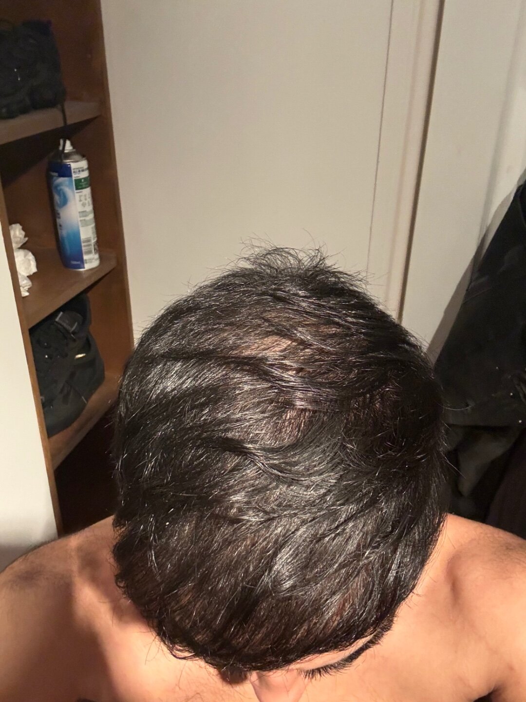 Repair hair transplant needed - Page 2 - Hair Restoration Questions and ...