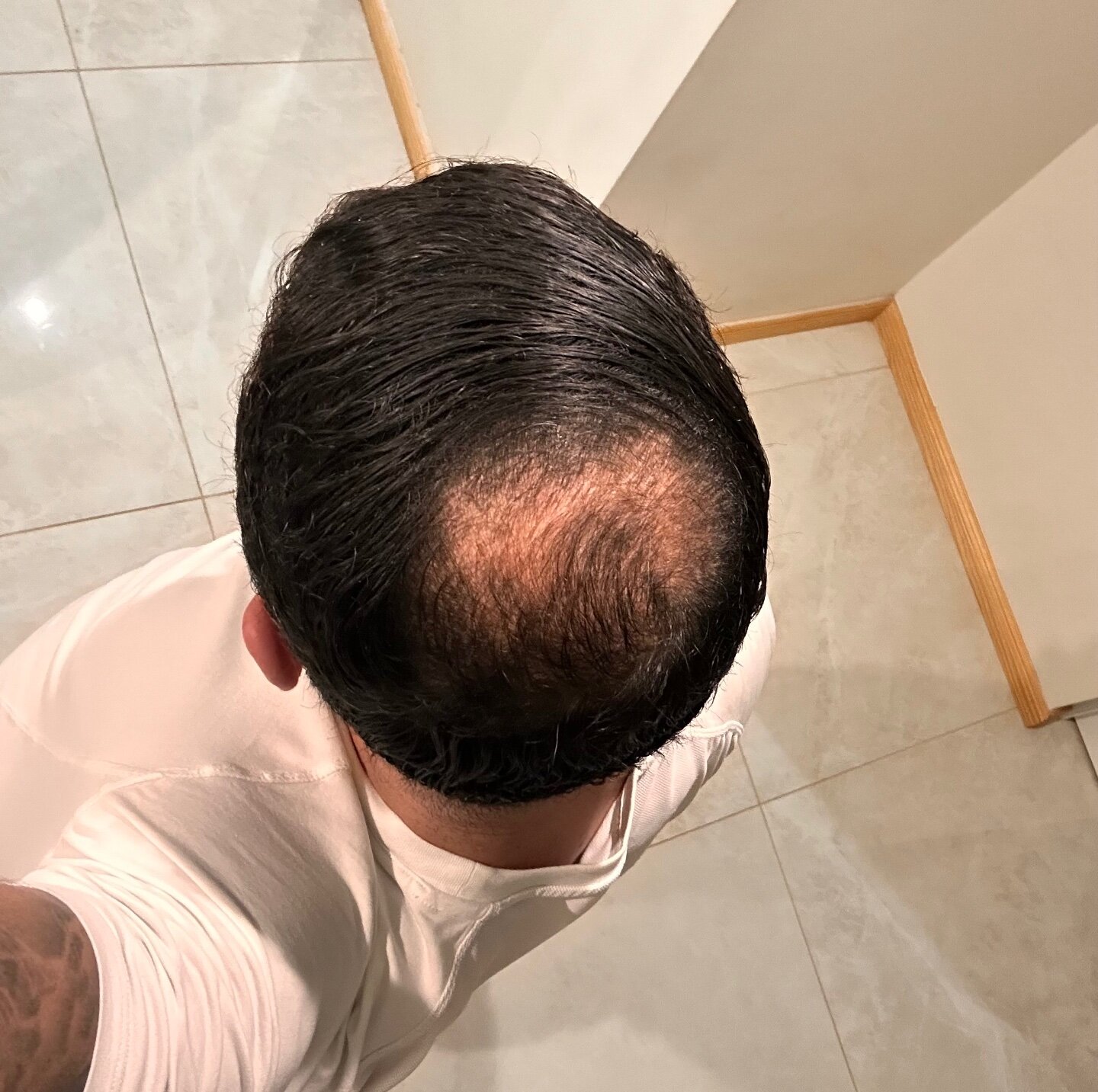 My hair is improving with natural supplements etc - Hair Restoration ...