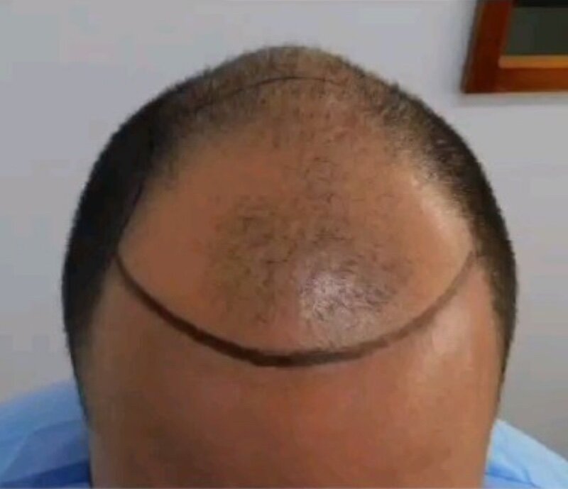 v-shape vs u-shape hairline - which hairline shape do you prefer and ...