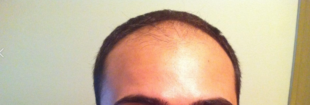 2x Konior FUT scar fill in w/ 400 beard + SMP - Hair Transplant Reviews ...
