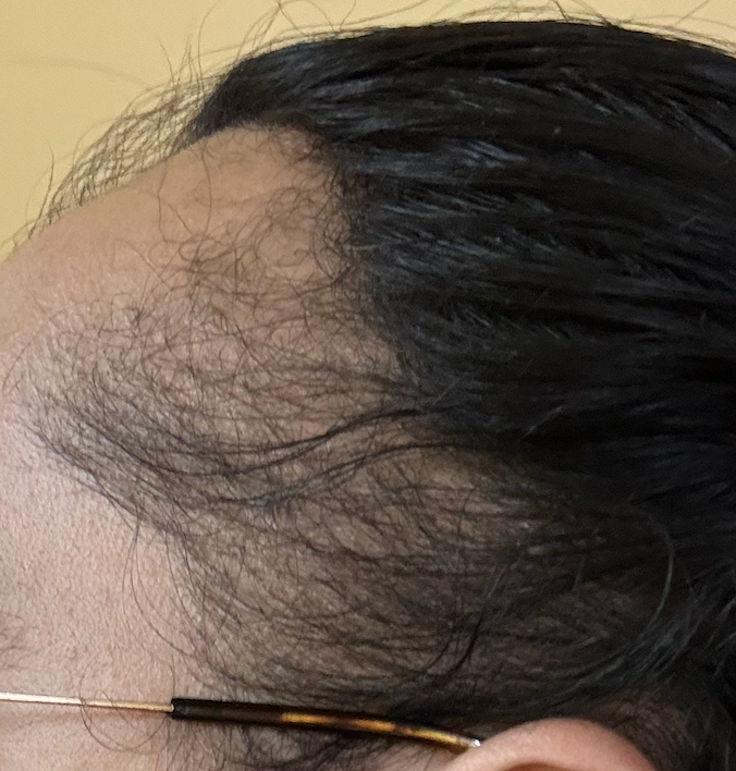 Can hair transplant restore hair on temporal & parietal region - Hair ...