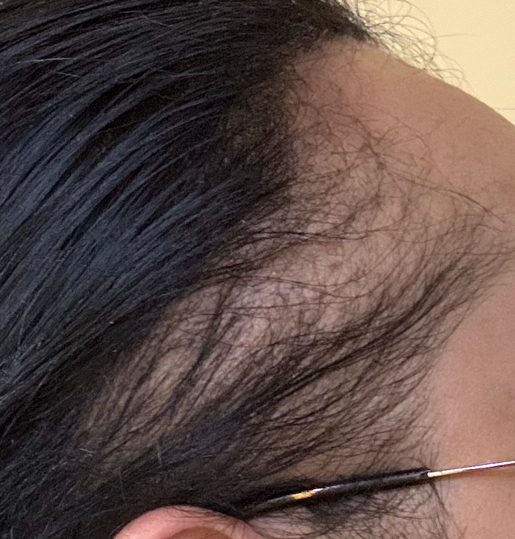 Can hair transplant restore hair on temporal & parietal region - Hair ...