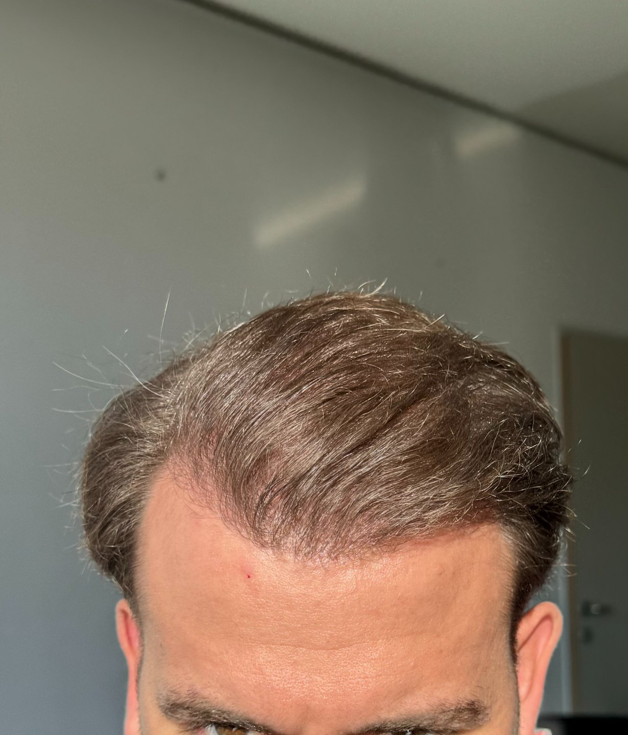 Which Dr.? Differ Dr Yaman - HT 16.4.23 - 4360 Grafts - Hair ...