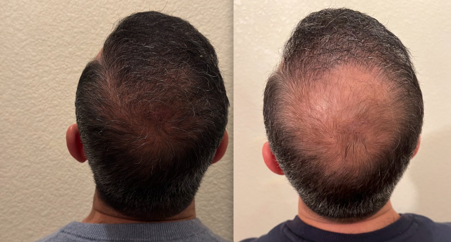 Crown and Mid Scalp Dr. GUR/FUECAPILAR (2040 Grafts) 8/22/23 - Hair ...