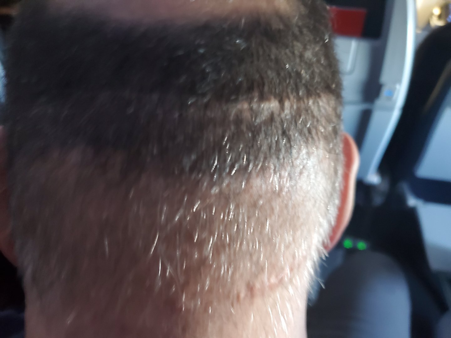 Choosing NW 7 doctor - Hair Restoration Questions and Answers - Hair ...