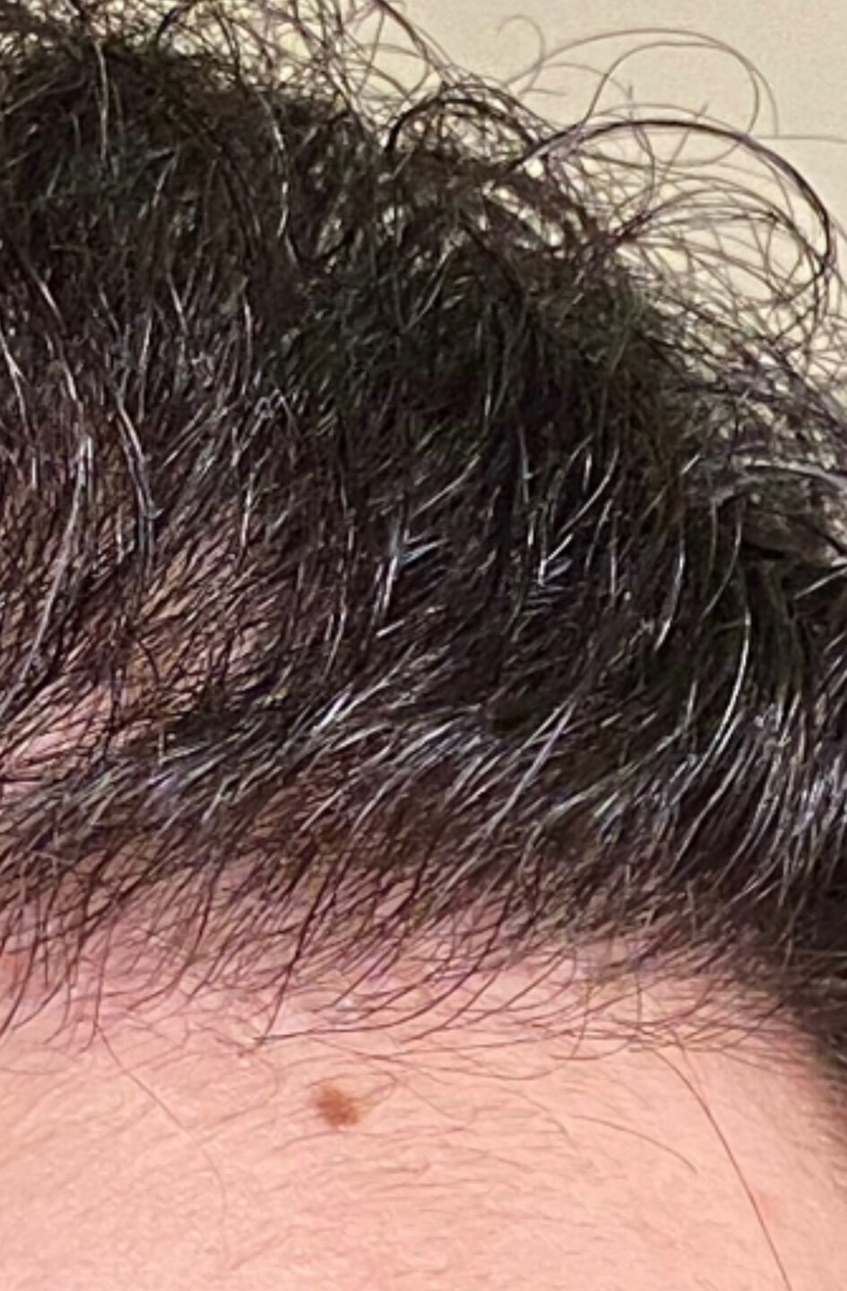Dr. Christina Vryonidou (HDC Cyprus) -- 7900 FUE Grafts, 2 Surgeries ...